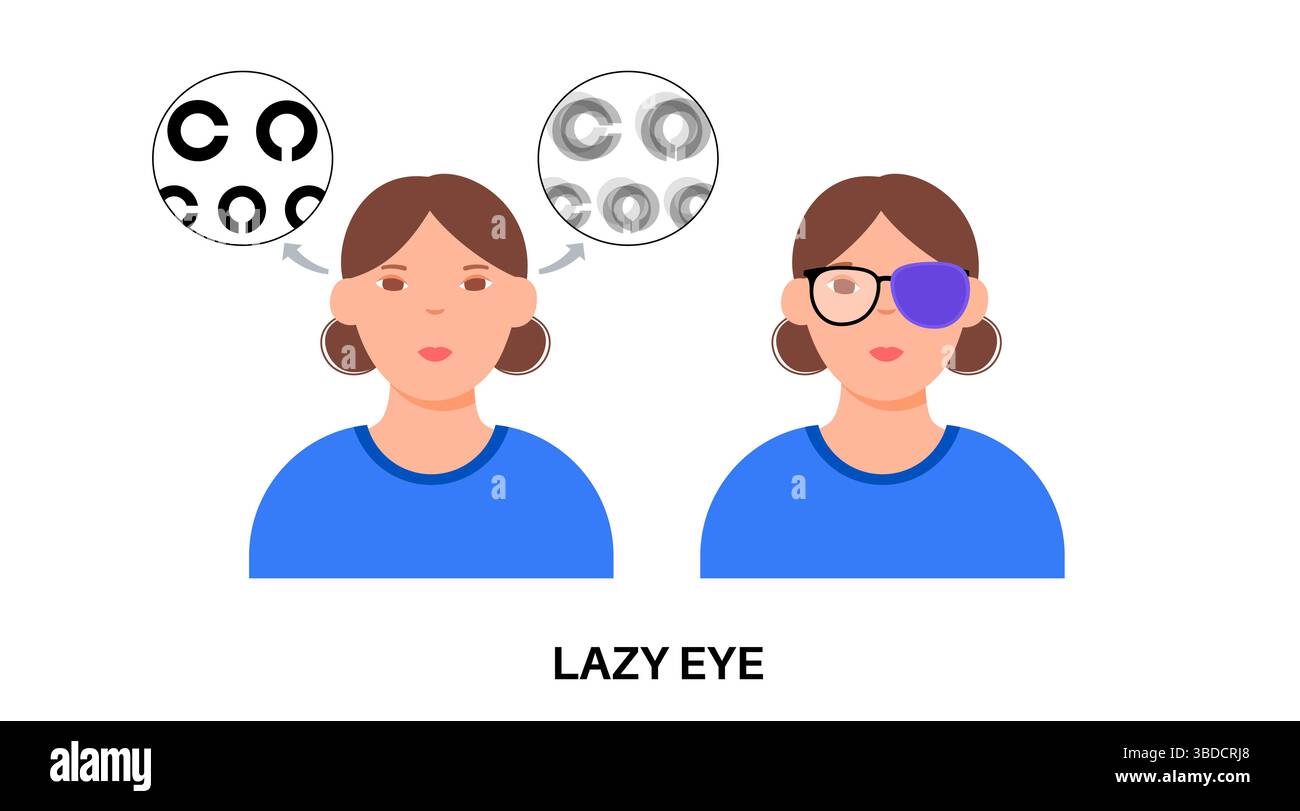 Illustration of amblyopia, also called lazy eye. This is reduced vision ...