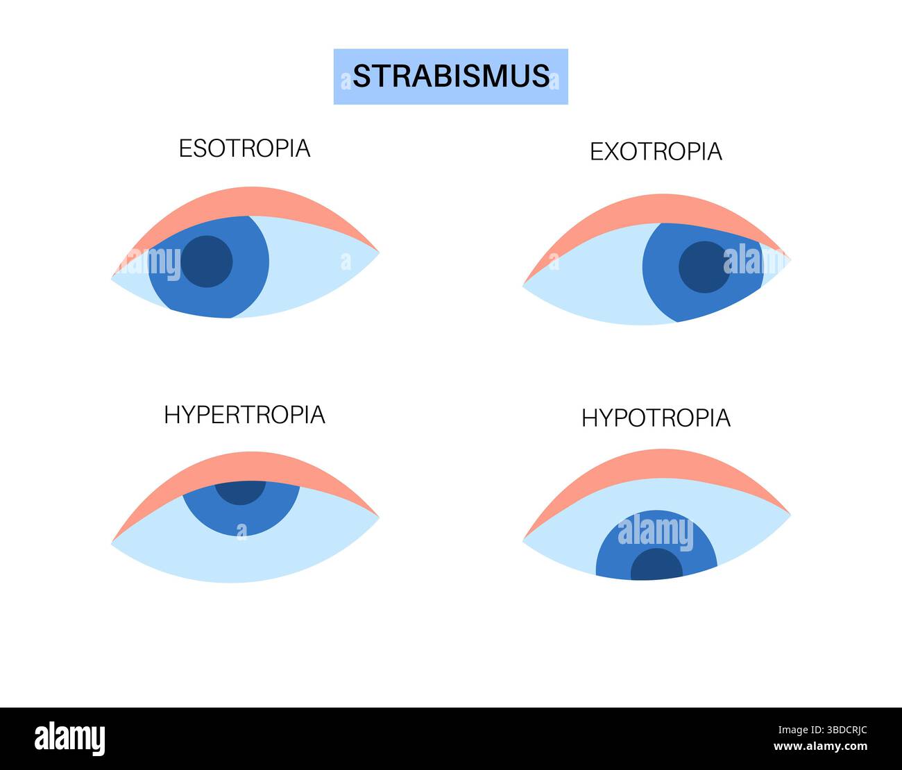 Illustration of strabismus. Also known as eye misalignment, this is a ...