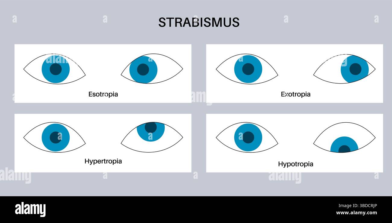 Illustration of strabismus. Also known as eye misalignment, this is a ...