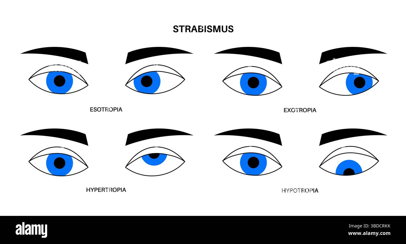 Illustration of strabismus. Also known as eye misalignment, this is a ...