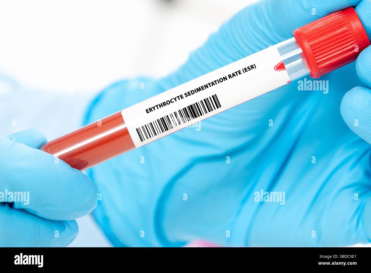Erythrocyte sedimentation rate (ESR) test. Measures how quickly red ...