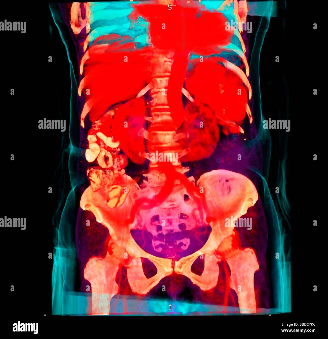 Coloured computed tomography (CT) scan of a coronal section through a ...