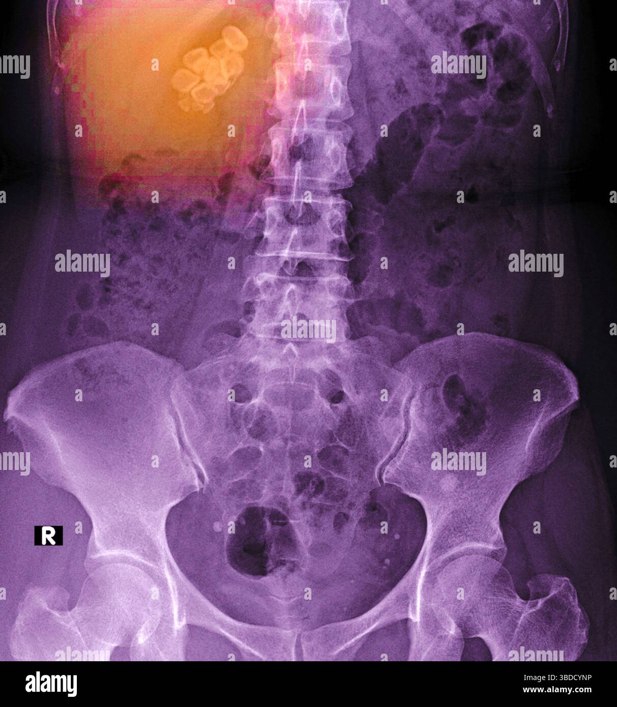 Coloured X-ray of gallstones (orange) in a patient's upper abdomen ...