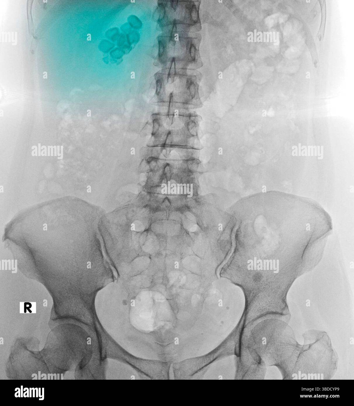 Coloured X-ray of gallstones (blue) in a patient's upper abdomen ...