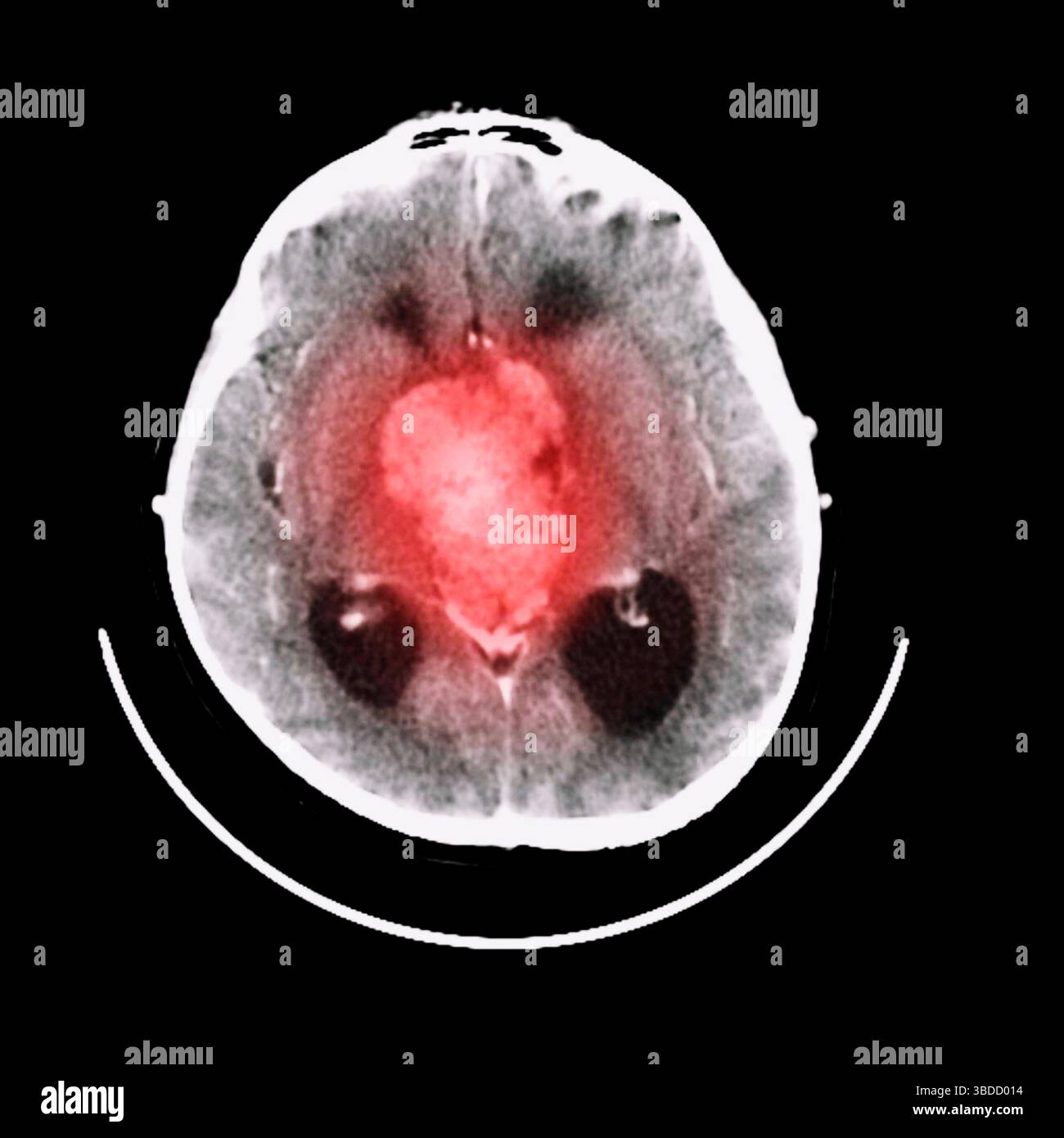 Coloured computed tomography (CT) scan of the brain of a patient ...