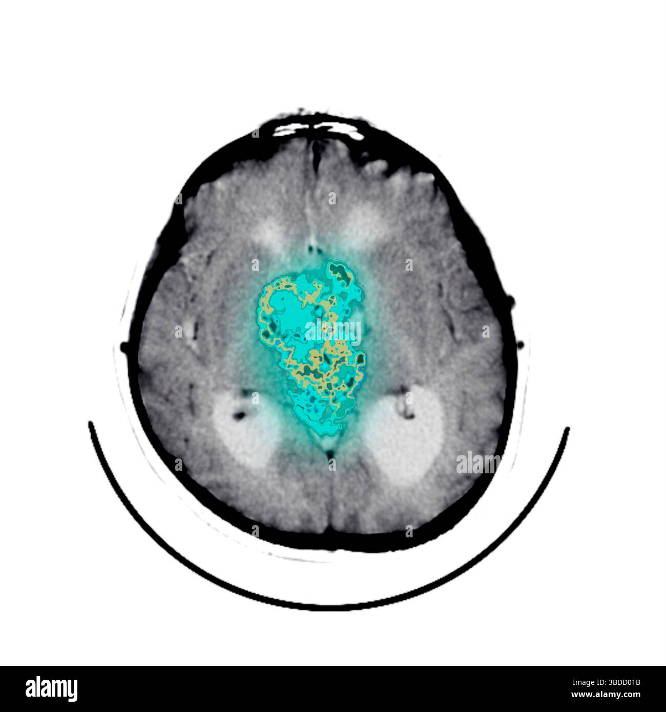 Coloured computed tomography (CT) scan of the brain of a patient showing an ependymoma (green ...
