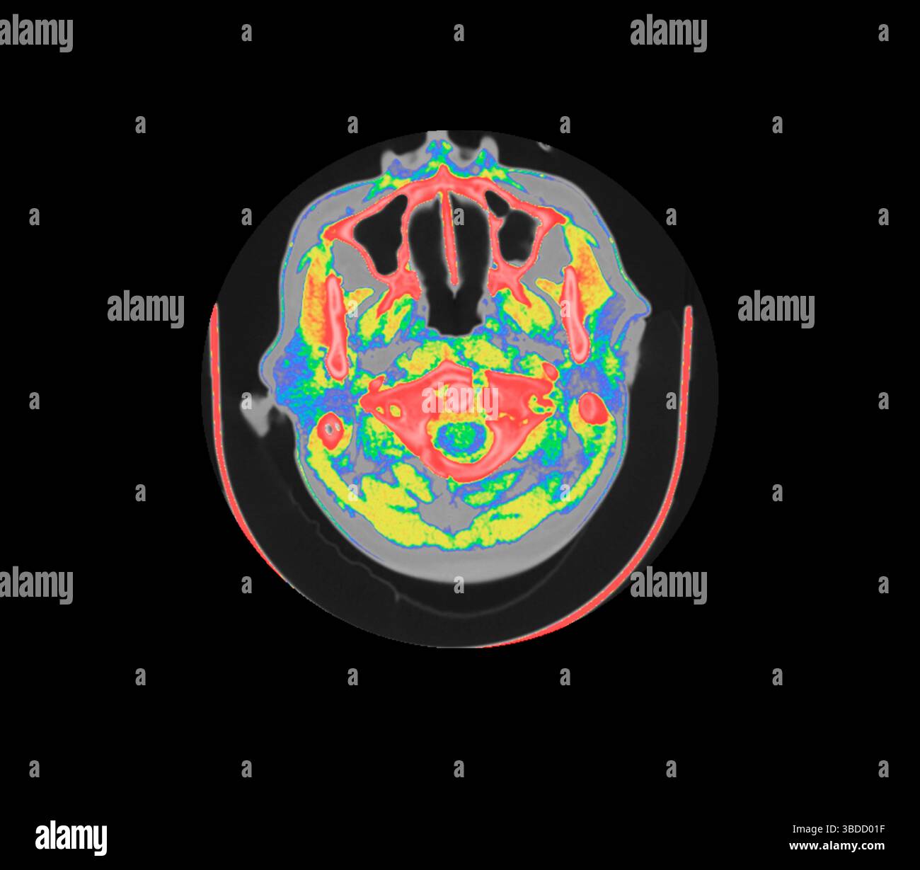 Coloured Computed Tomography Ct Scan Of A Jefferson Fracture A
