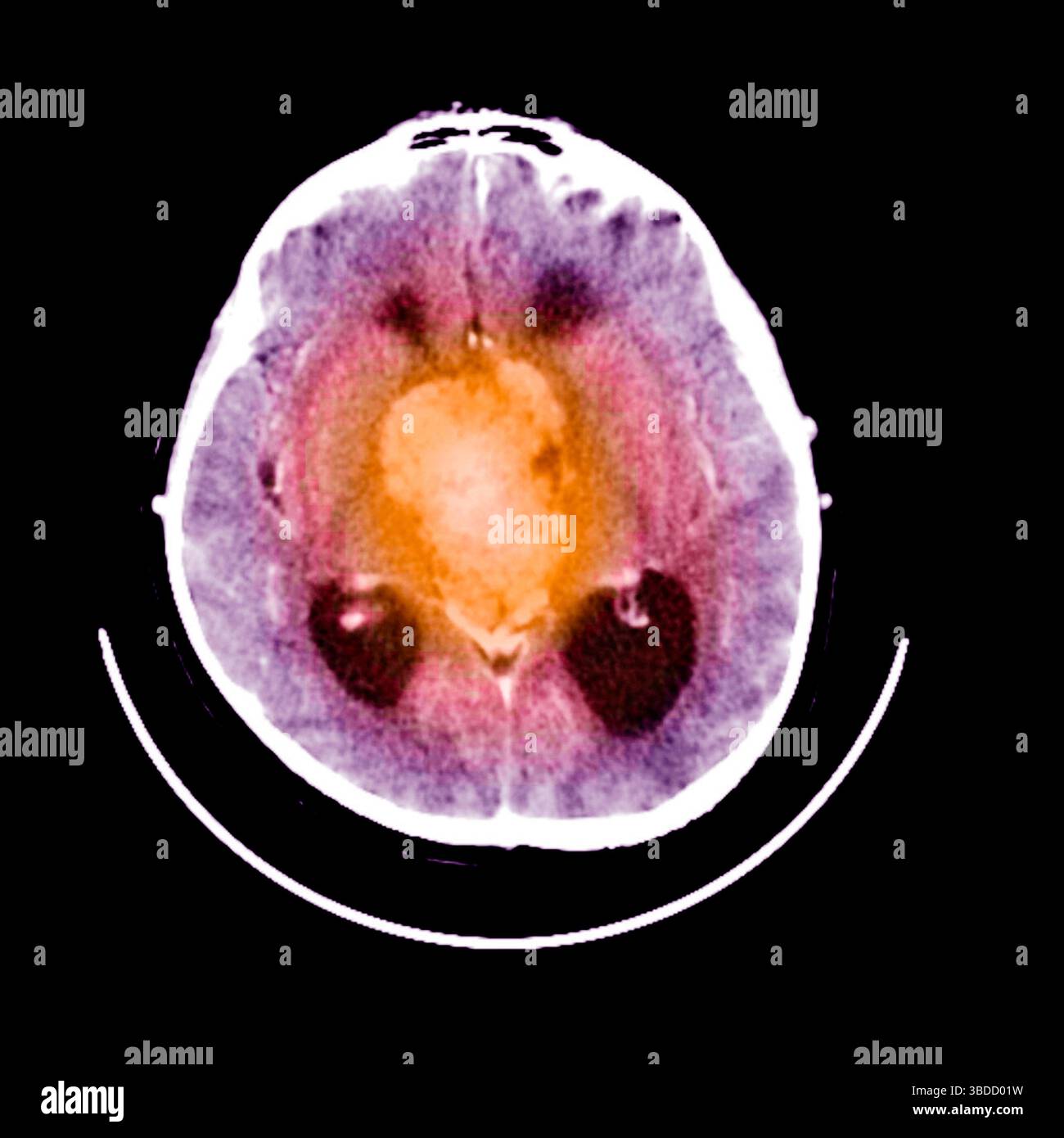 Coloured computed tomography (CT) scan of the brain of a patient showing an ependymoma (orange ...