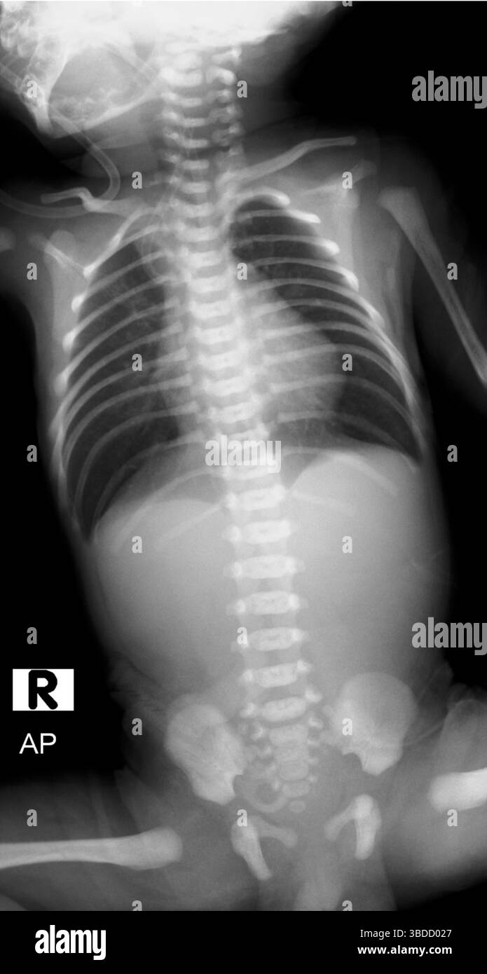 X-ray of a newborn baby with oesophageal atresia (in lower neck) and ...