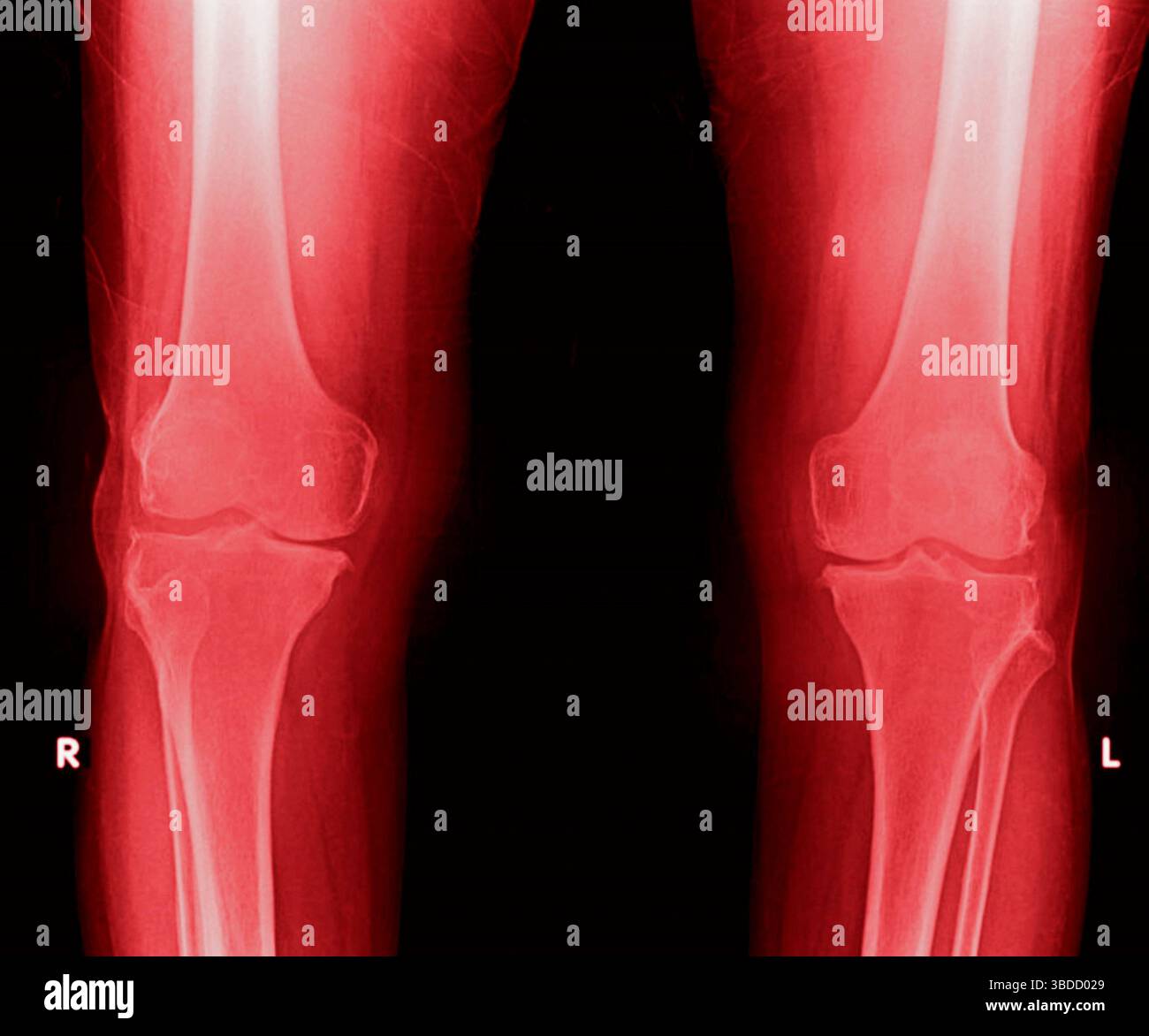 Coloured X-ray of the knees of a patient with osteoarthritis ...