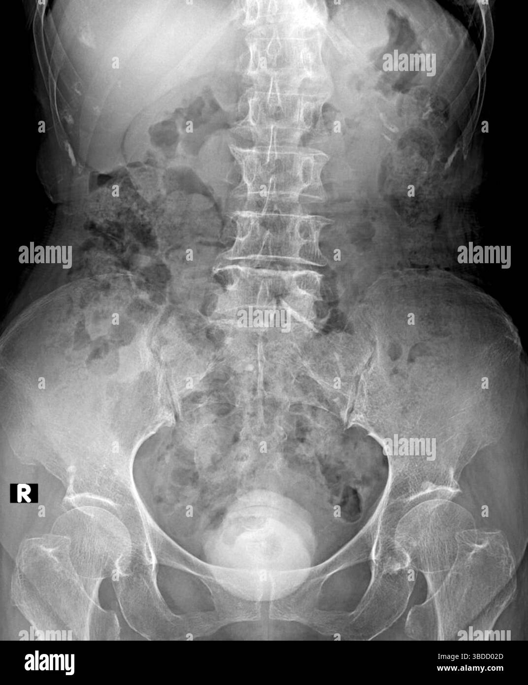 X-ray of bladder stones (grey) in the urinary bladder (white, bottom ...