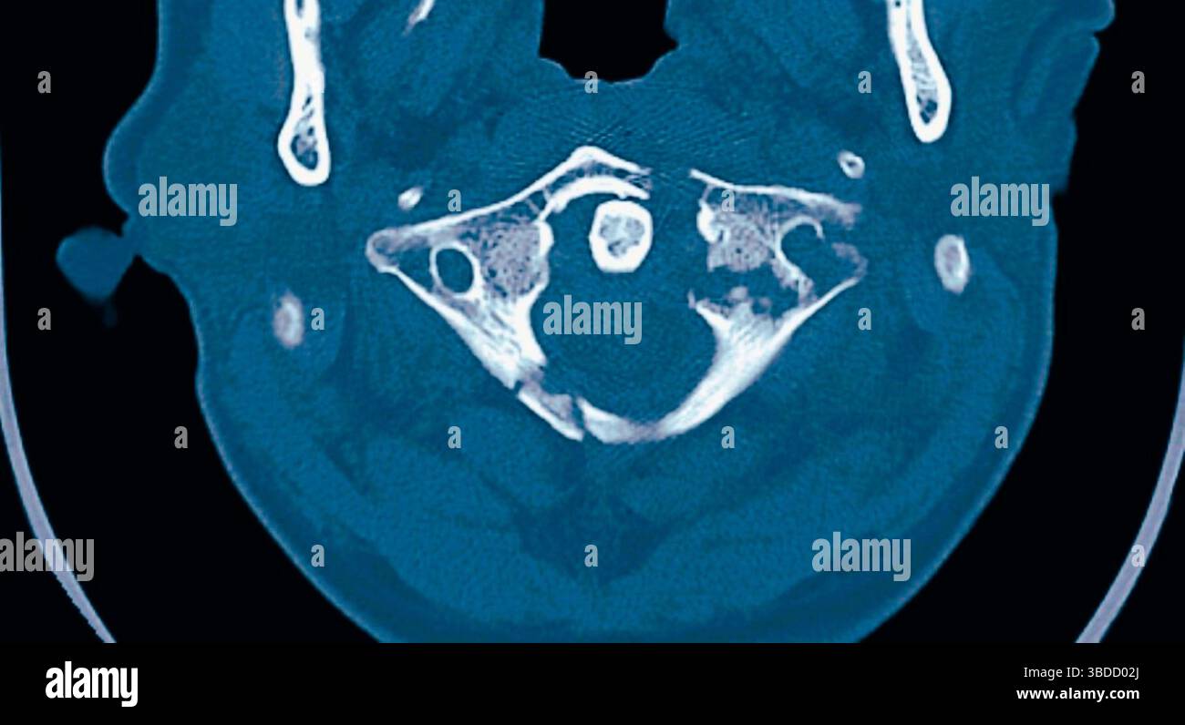 Coloured computed tomography (CT) scan of a Jefferson fracture, a ...