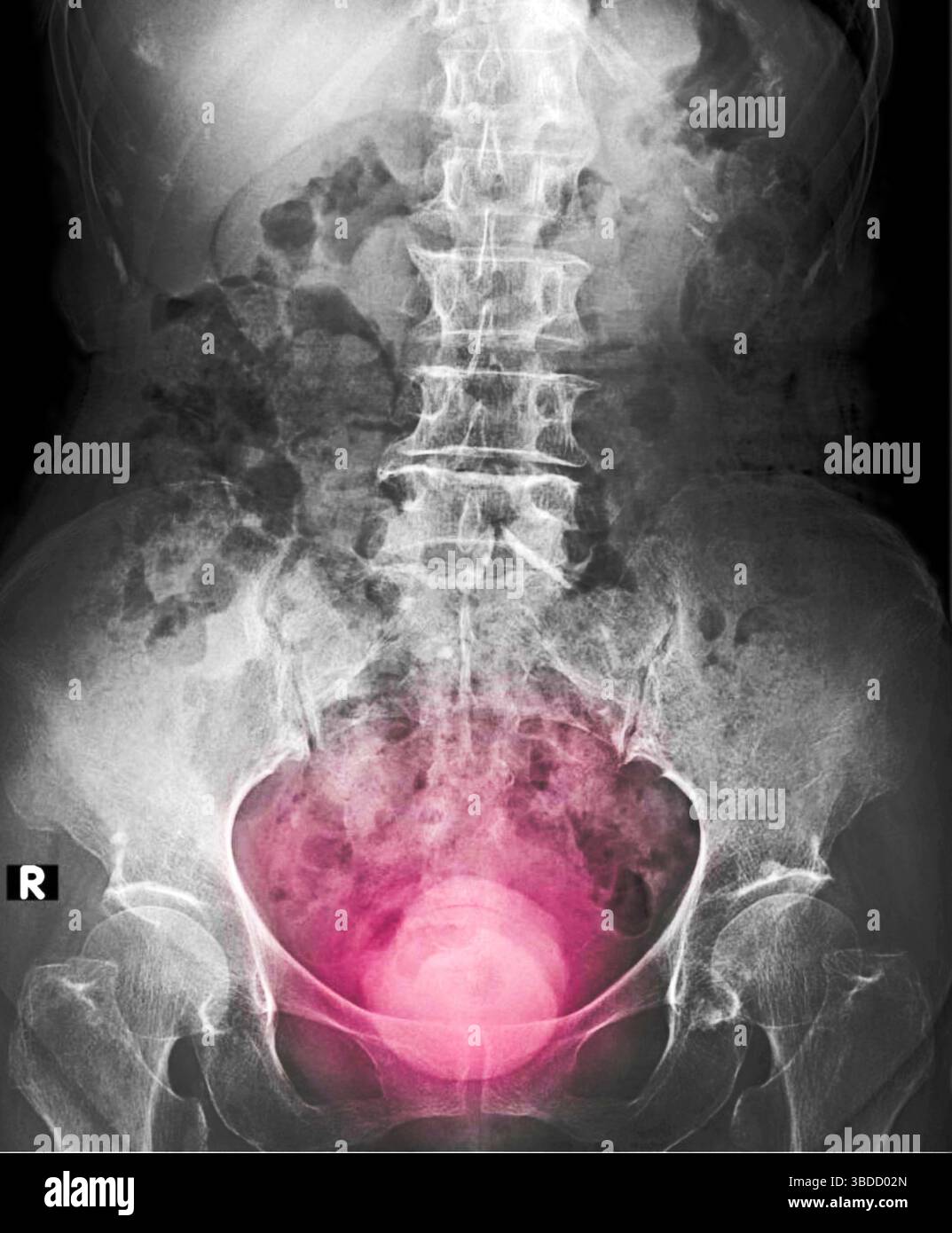 Coloured X-ray of bladder stones (grey) in the urinary bladder (pink ...