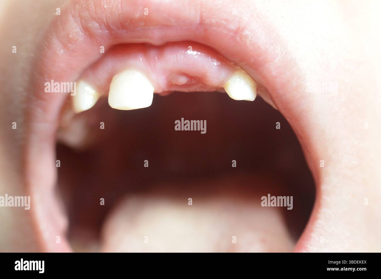 Lost deciduous primary baby temporary tooth, the first set of teeth in ...