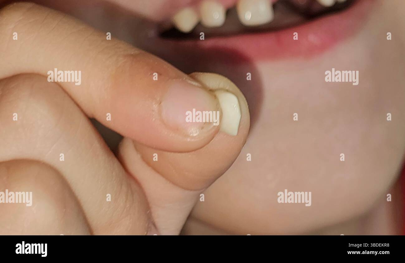 Lost deciduous primary baby temporary tooth, the first set of teeth in ...