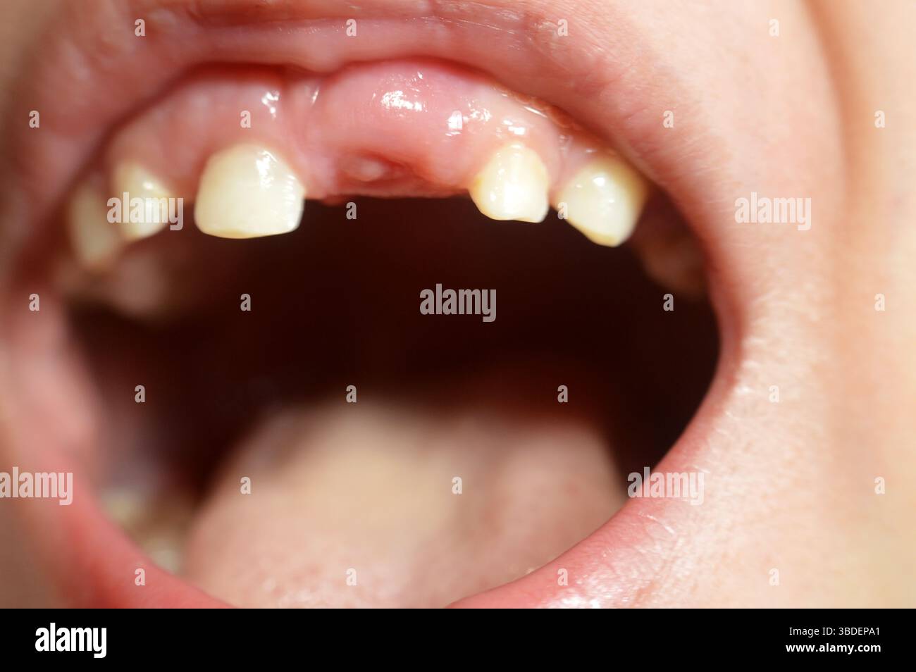 Lost deciduous primary baby temporary tooth, the first set of teeth in ...
