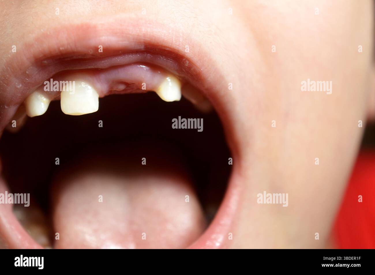 Lost deciduous primary baby temporary tooth, the first set of teeth in ...