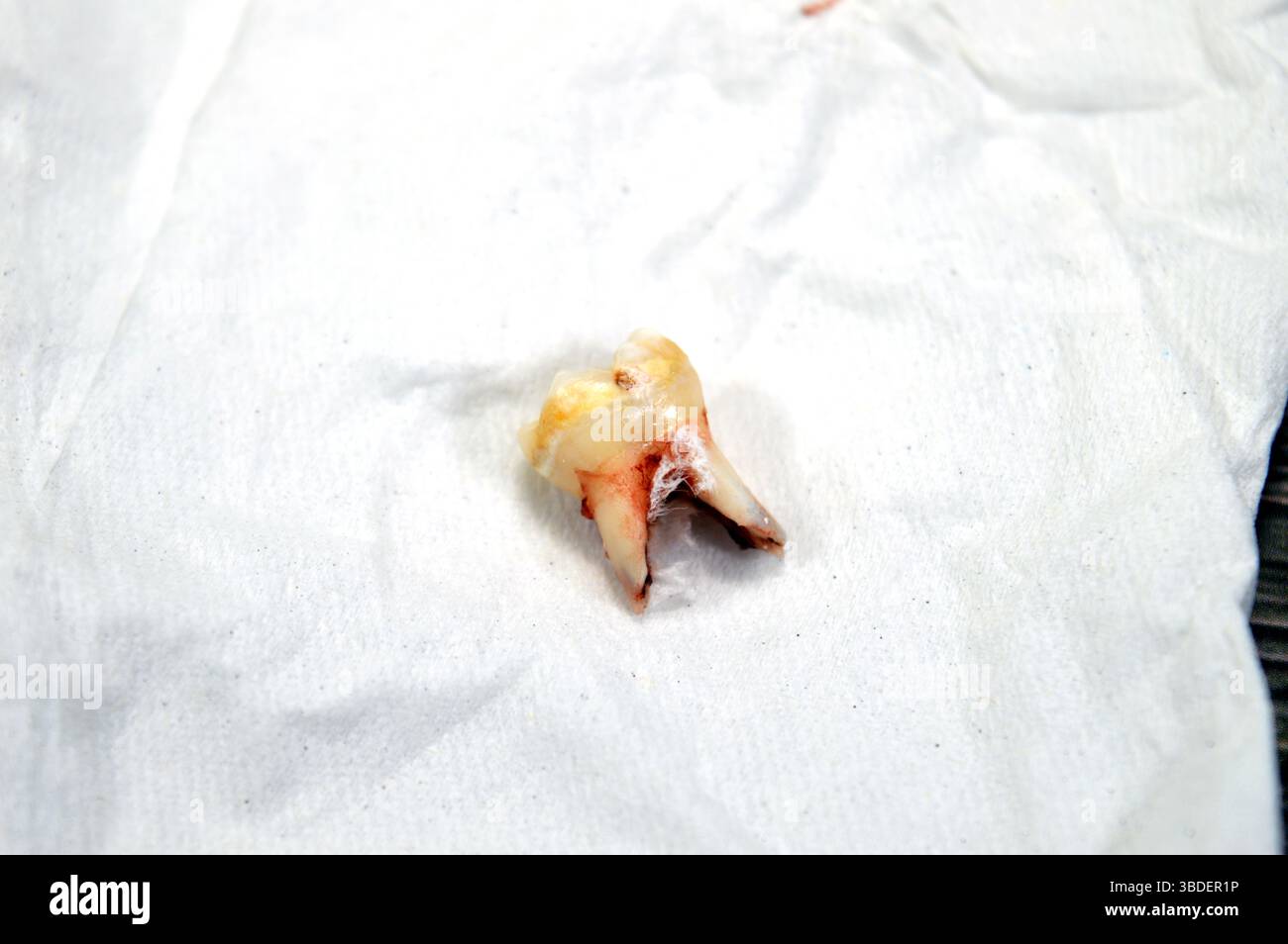 An extracted deciduous primary baby temporary teeth, the first set of ...