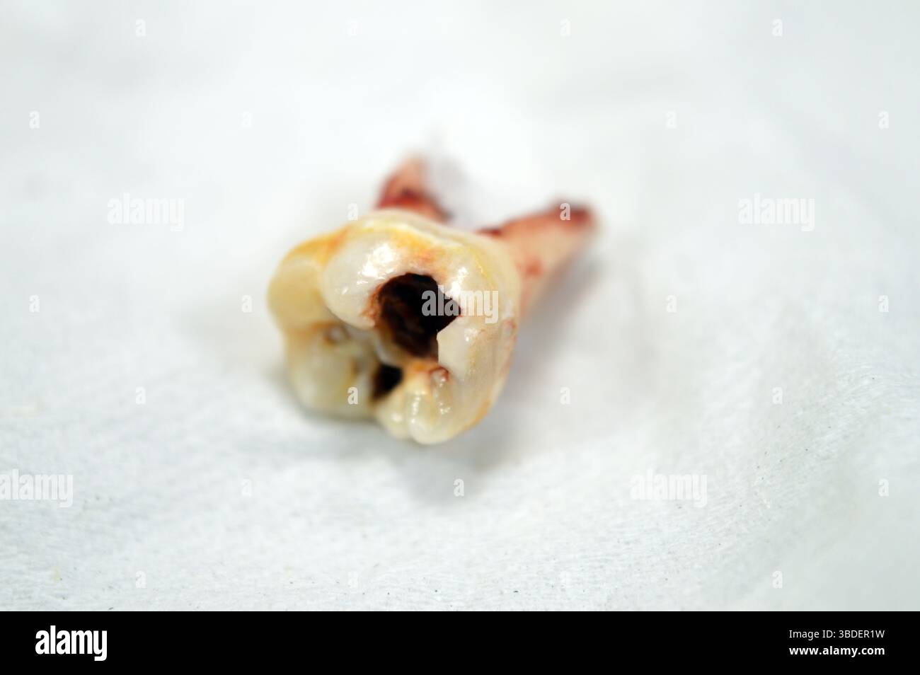 An extracted deciduous primary baby temporary teeth, the first set of ...