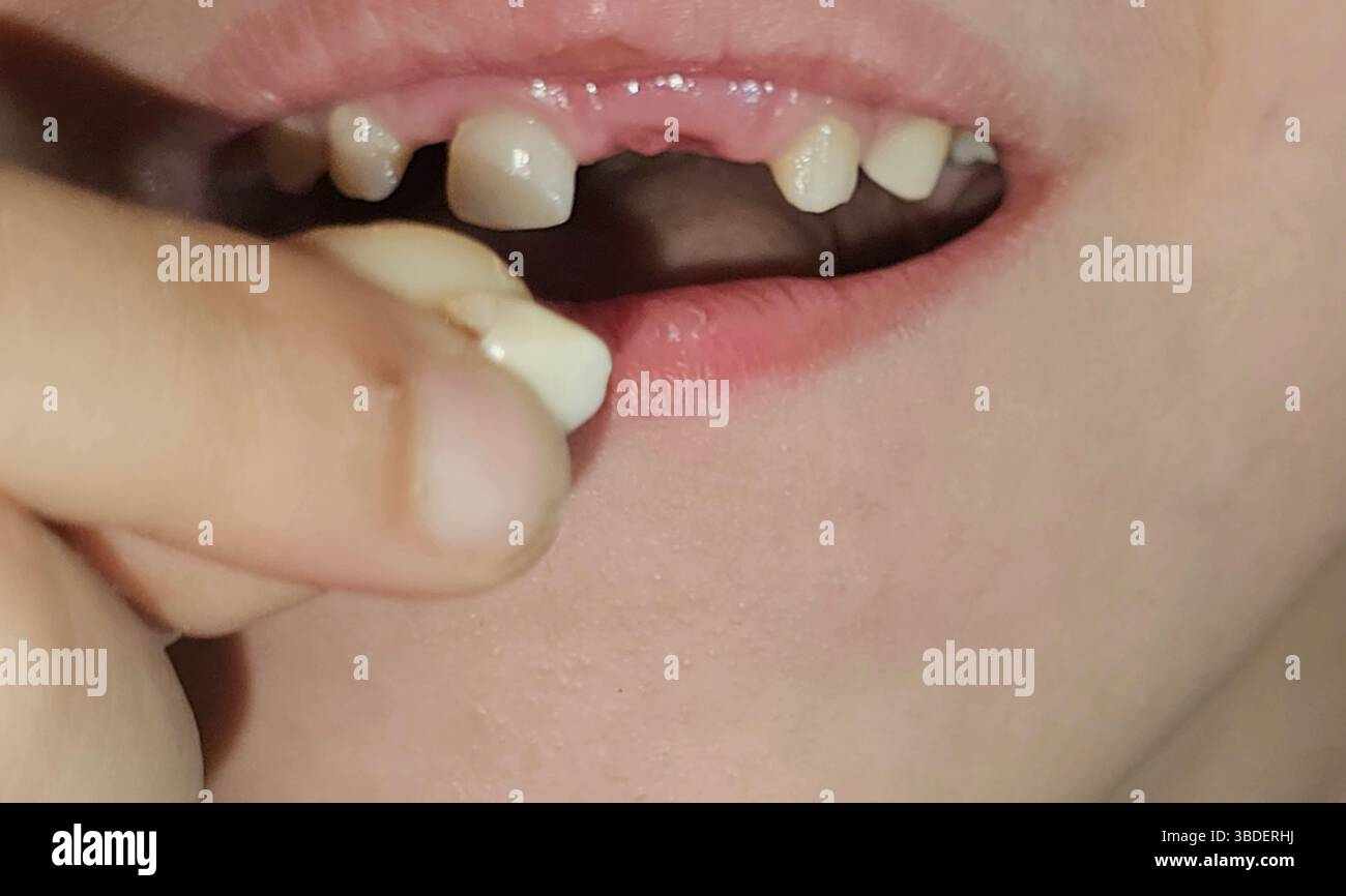 Lost deciduous primary baby temporary tooth, the first set of teeth in ...