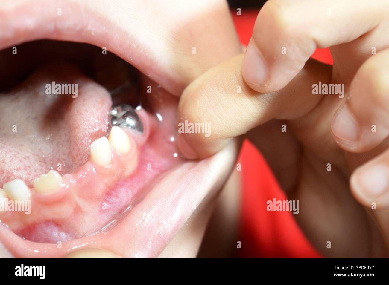 A 7 years old child, with a stainless steel crown for a tooth after ...
