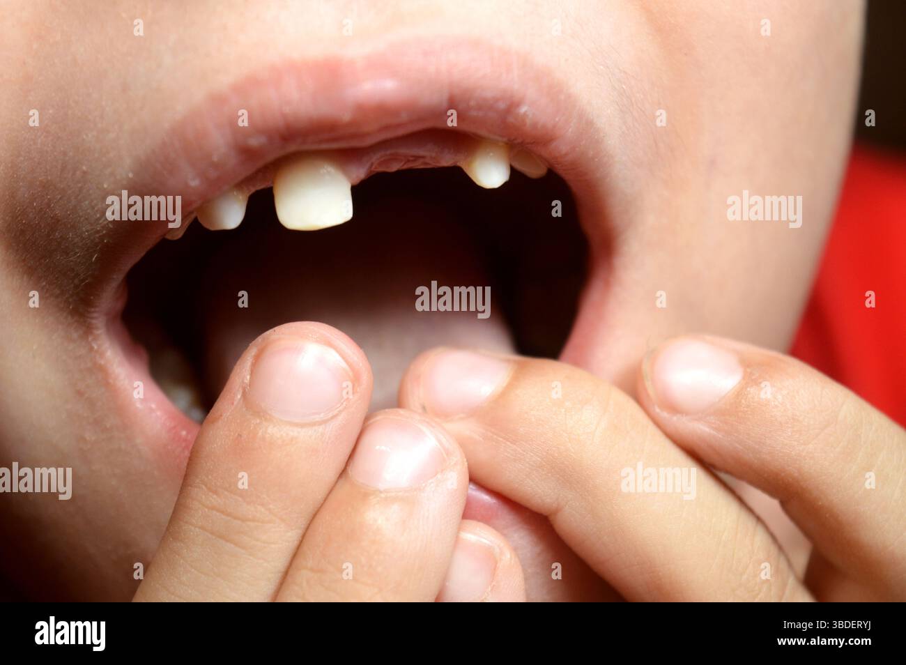 Lost deciduous primary baby temporary tooth, the first set of teeth in ...