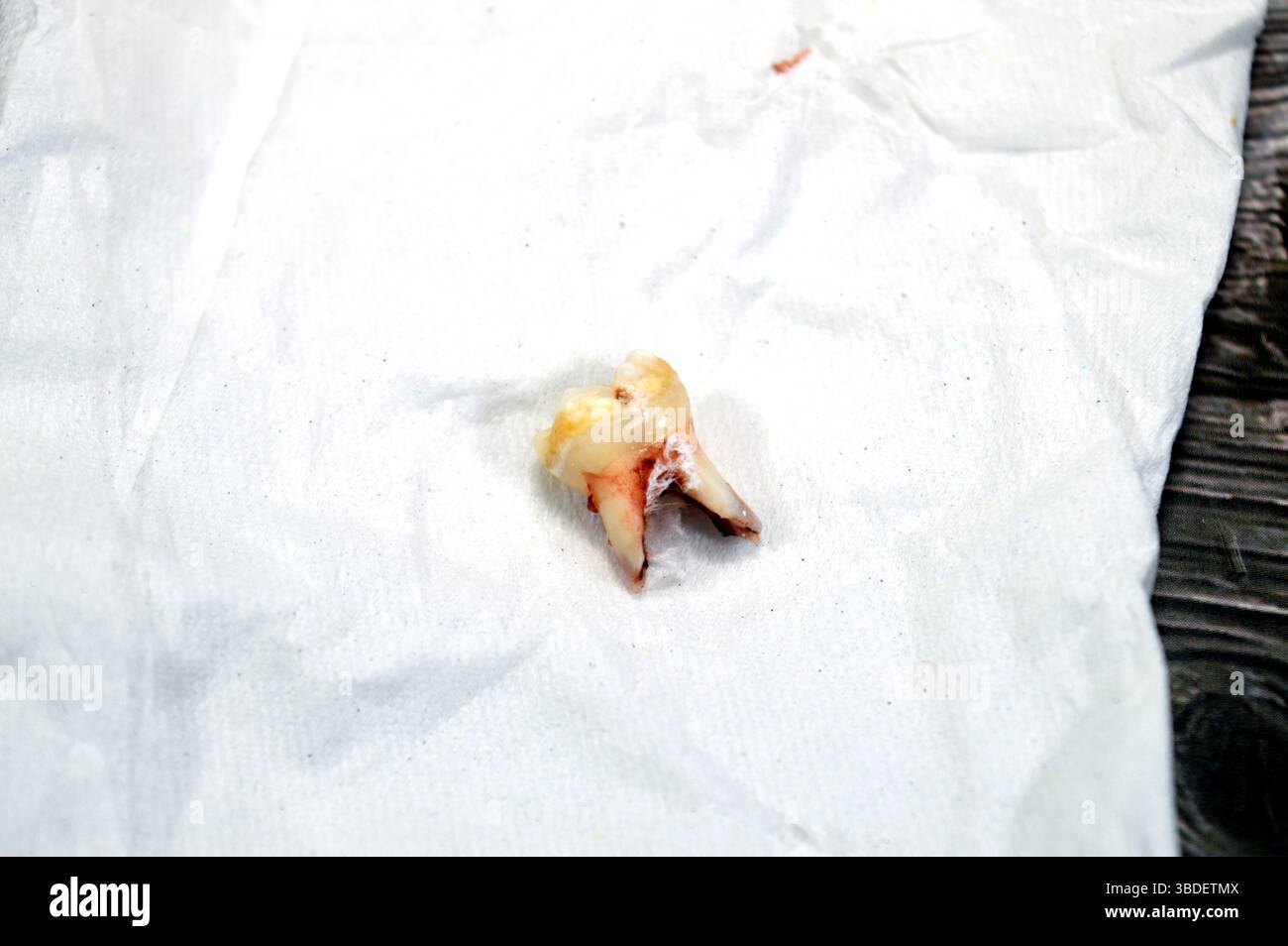 An extracted deciduous primary baby temporary teeth, the first set of ...