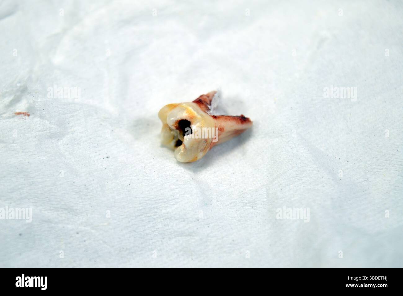 An extracted deciduous primary baby temporary teeth, the first set of ...