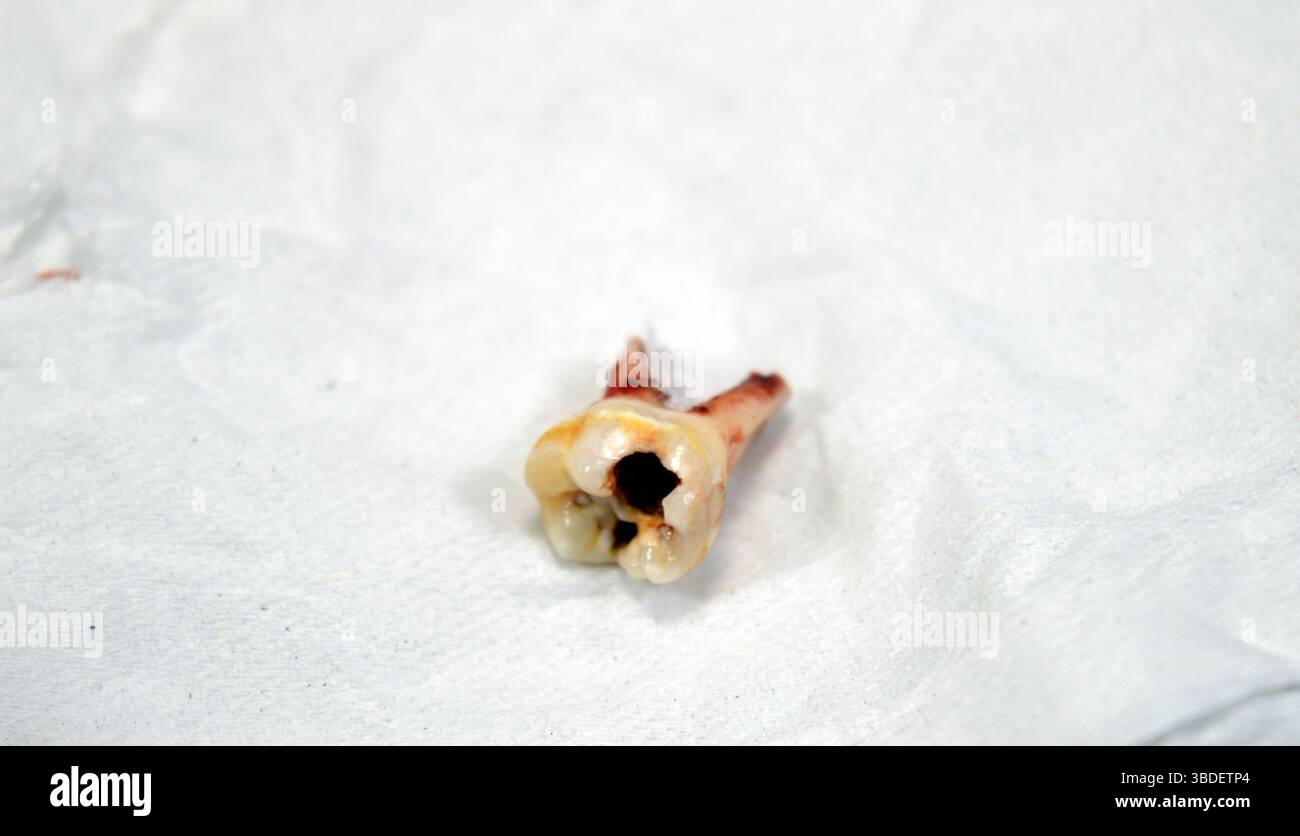 An extracted deciduous primary baby temporary teeth, the first set of ...