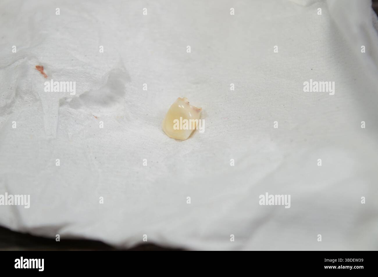 Lost deciduous primary baby temporary tooth, the first set of teeth in ...