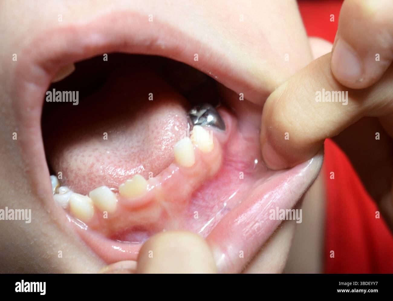 A 7 years old child, with a stainless steel crown for a tooth after ...