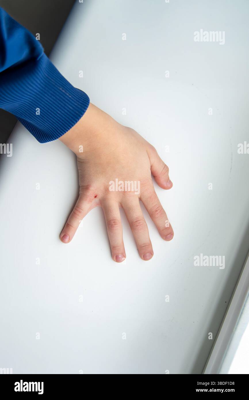 Dermatitis eczema face rash hi-res stock photography and images - Alamy