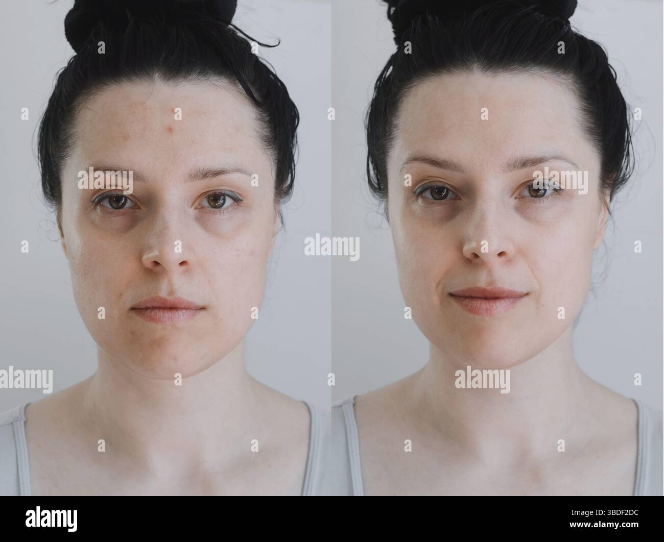 Female face long term comparison before and after cosmetic procedures ...