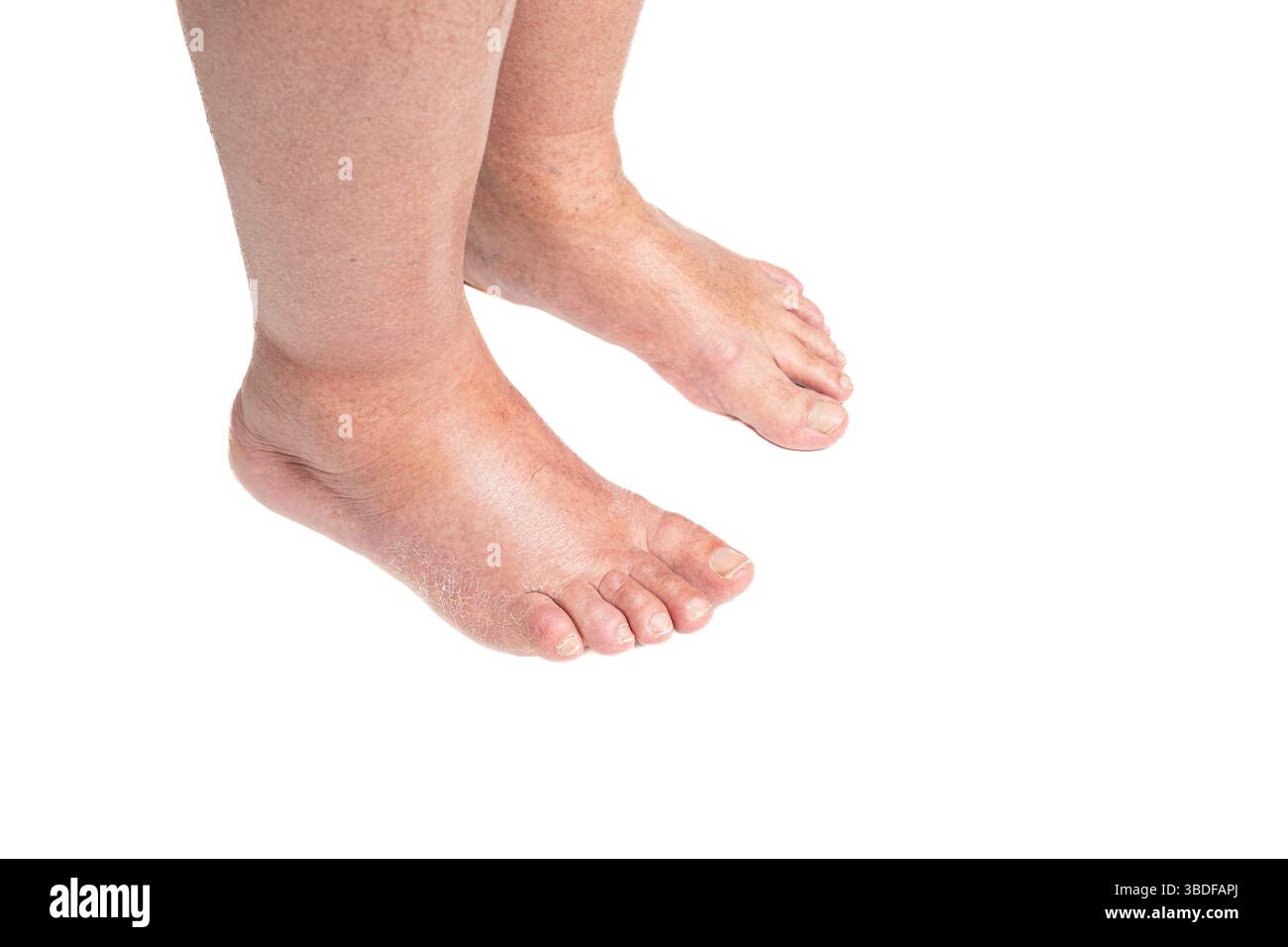 Swollen legs caused by a broken toe. Unrecognizable man with swollen ...