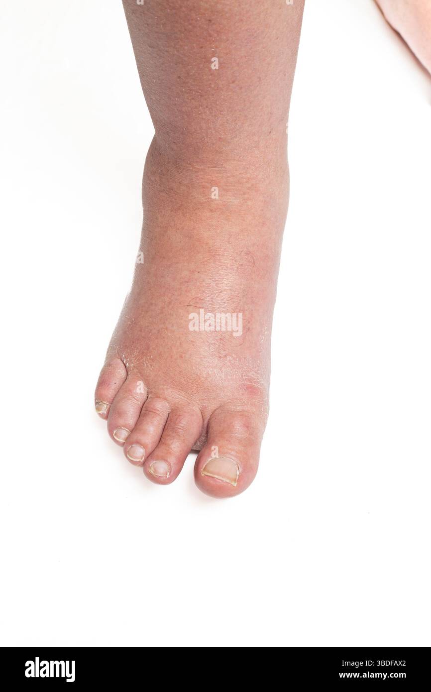 Swollen legs caused by a broken toe. Unrecognizable man with swollen ...