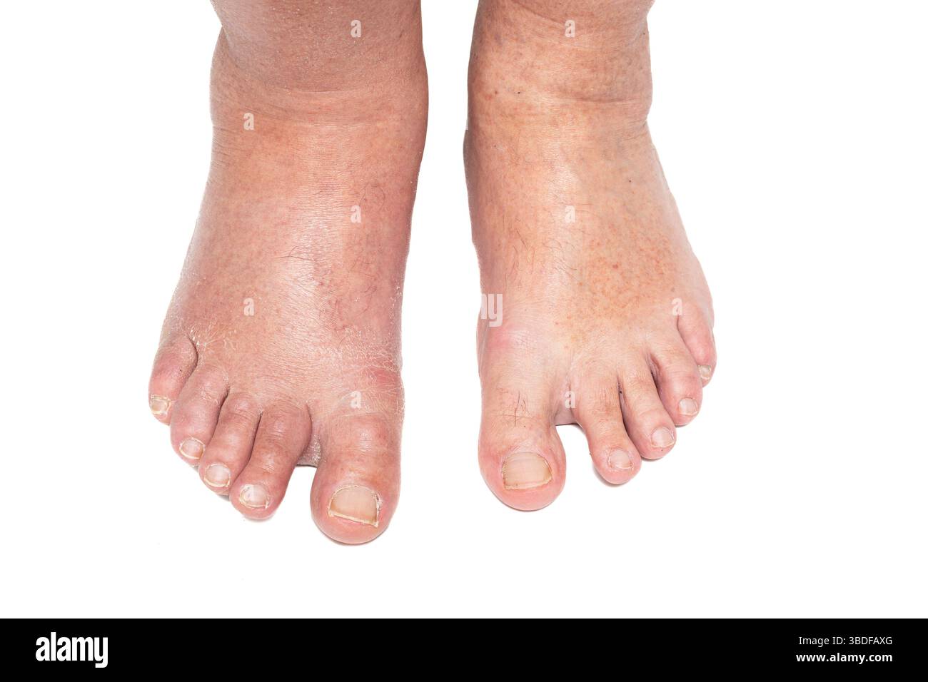 Swollen legs caused by a broken toe. Unrecognizable man with swollen ...