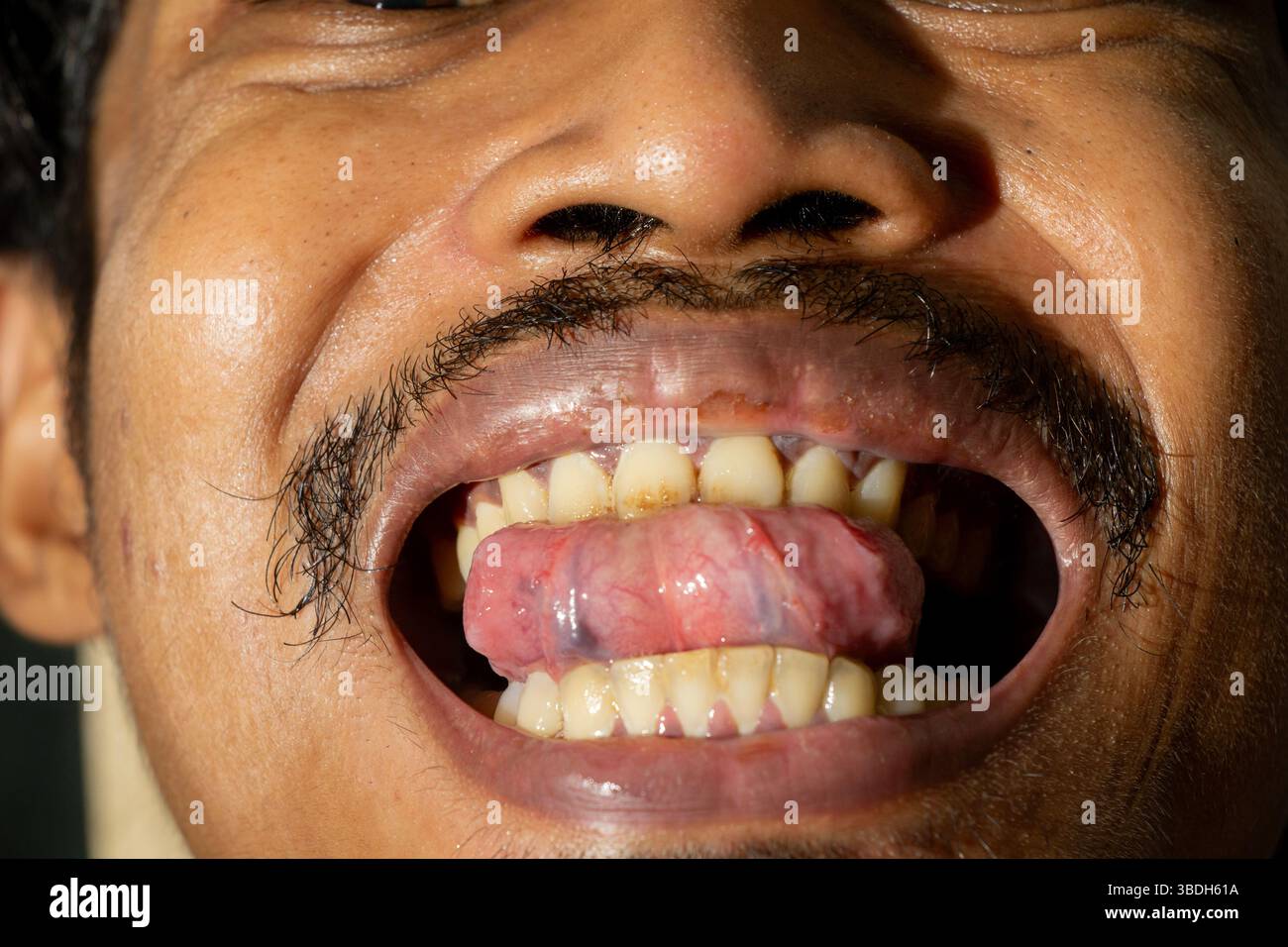 Tongue sores hi-res stock photography and images - Alamy