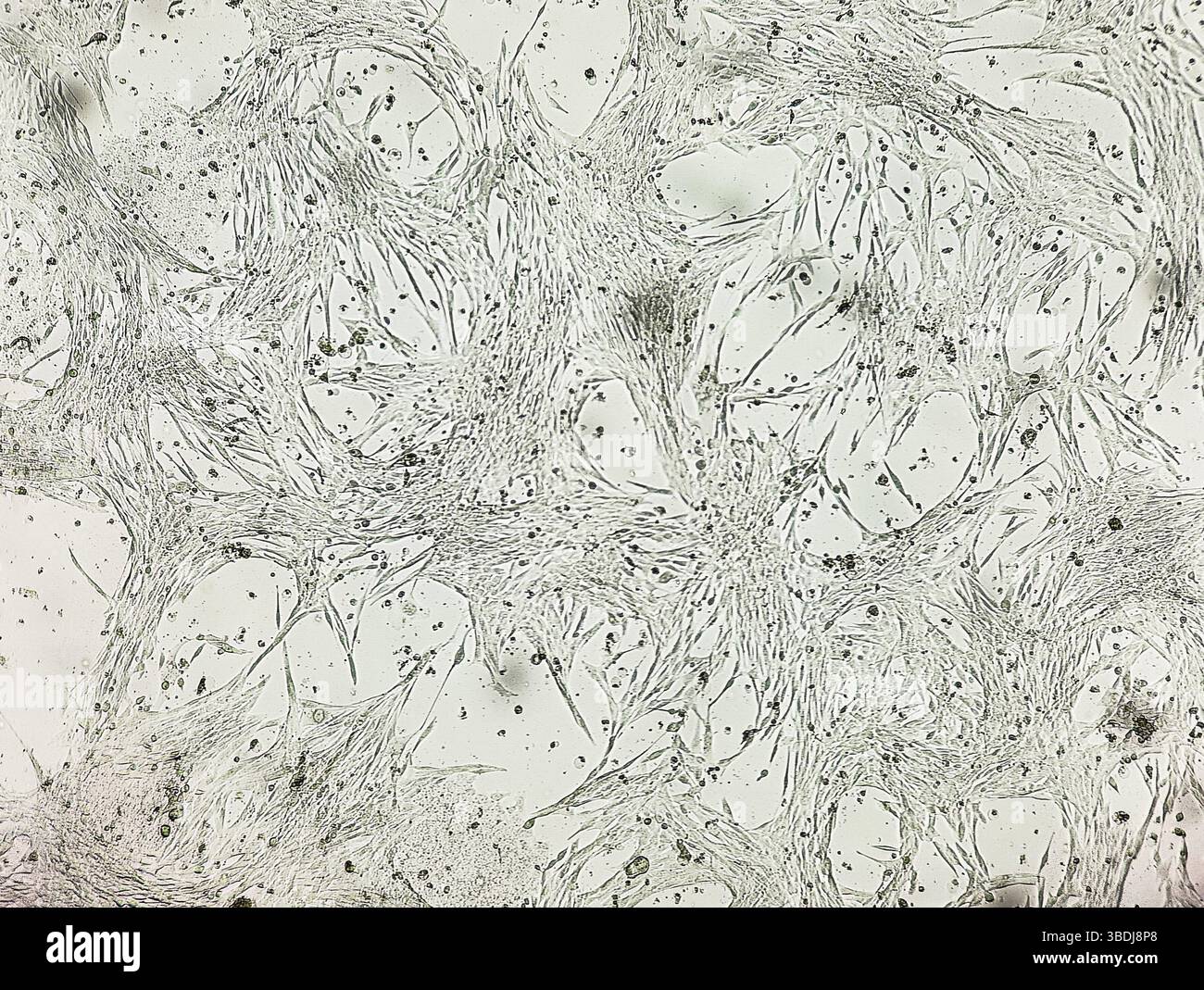 Glioblastoma cell culture. Human malignant astrocytoma cells under a ...