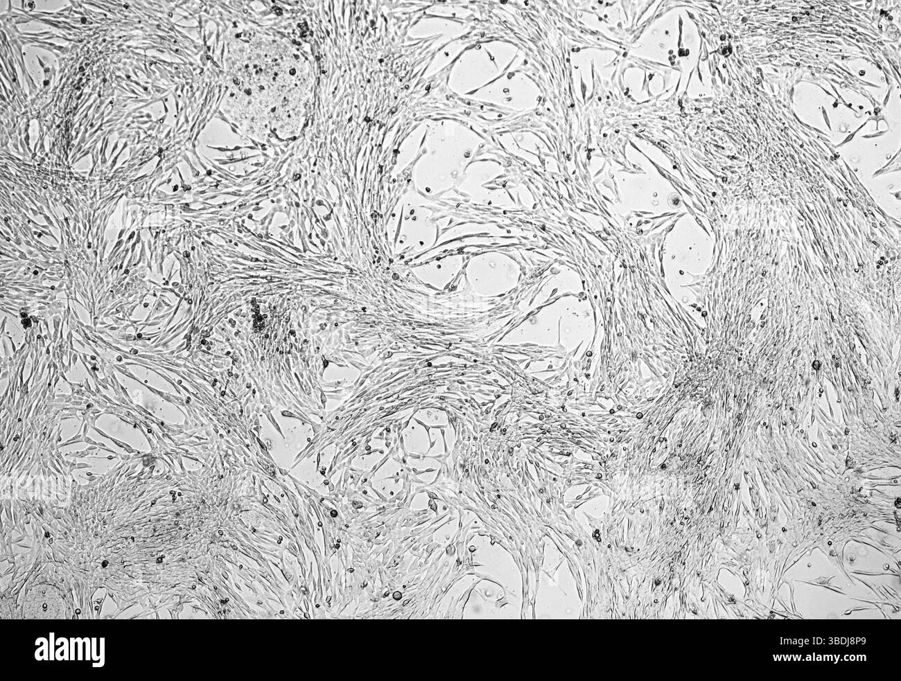 Glioblastoma cell culture. Human malignant astrocytoma cells under a ...