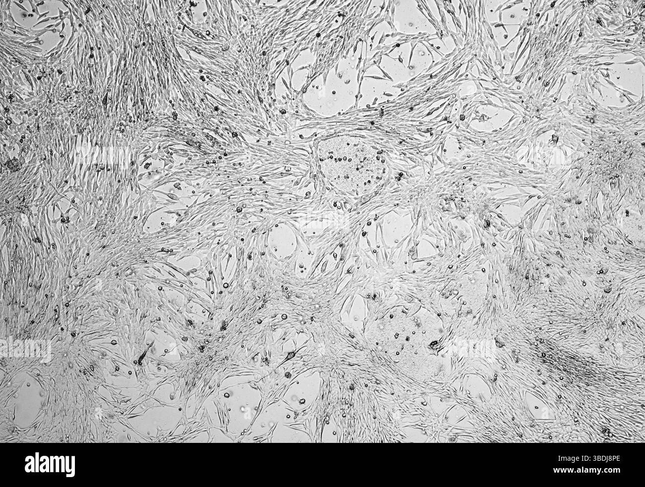 Glioblastoma cell culture. Human malignant astrocytoma cells under a ...