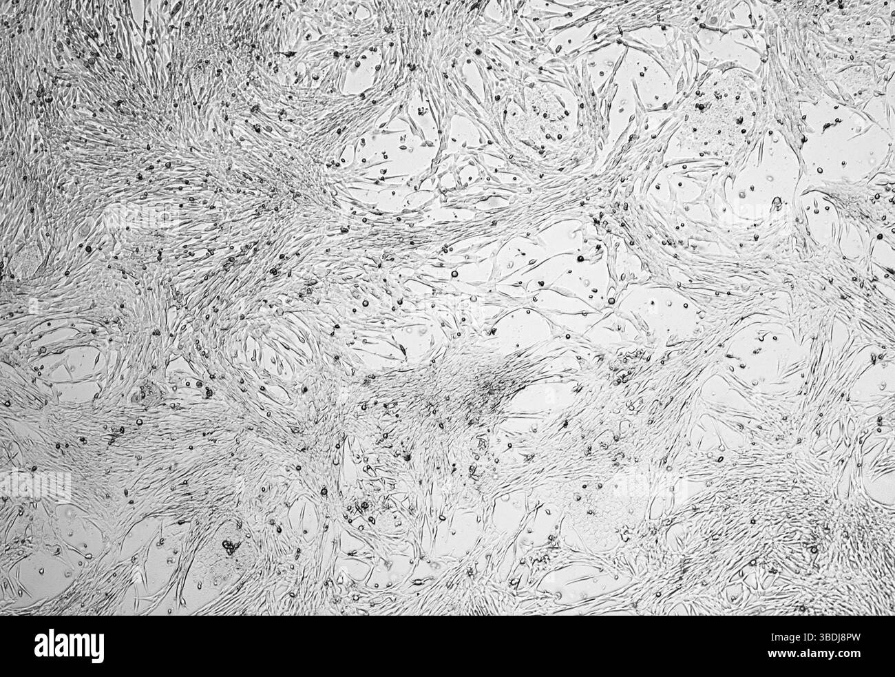 Glioblastoma cell culture. Human malignant astrocytoma cells under a ...