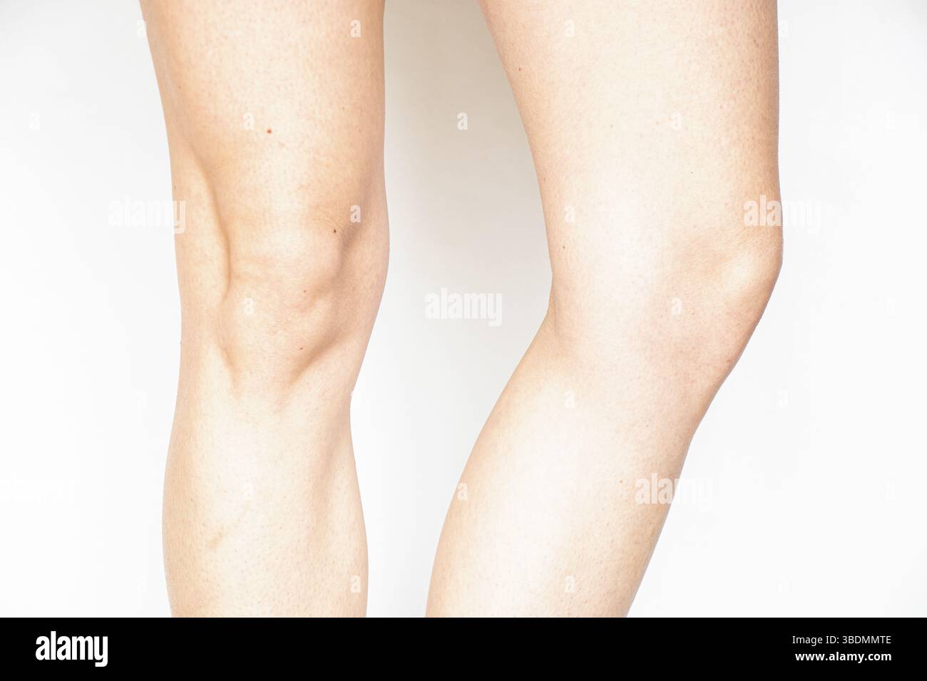 Female legs on white background, health, skin and medical examinations ...