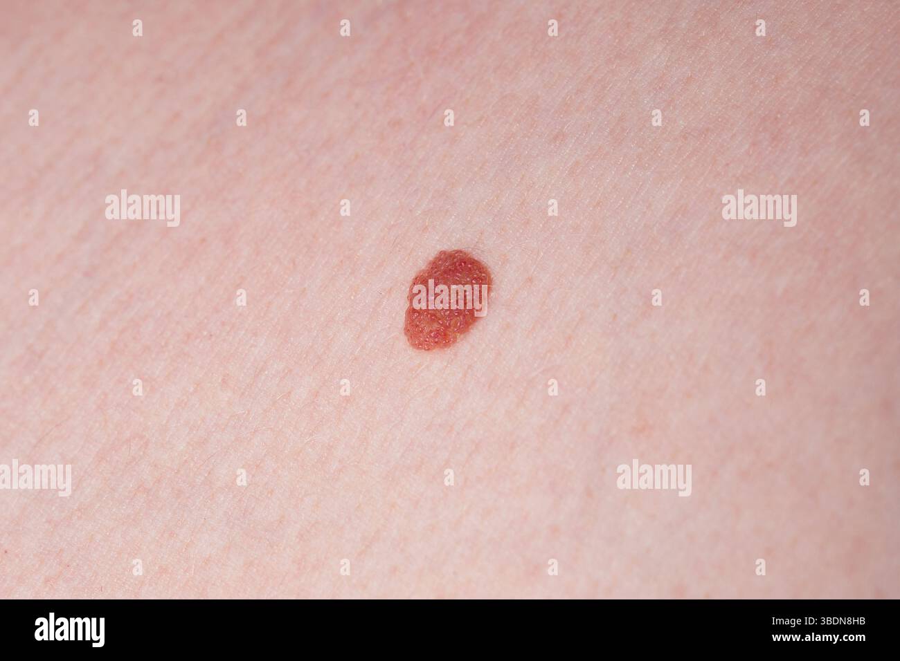 A benign mole on the body. Medical examination. Dermatologist ...