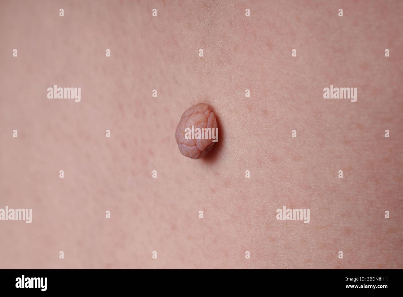 A large round papilloma, a benign mole on the body. Medical examination ...