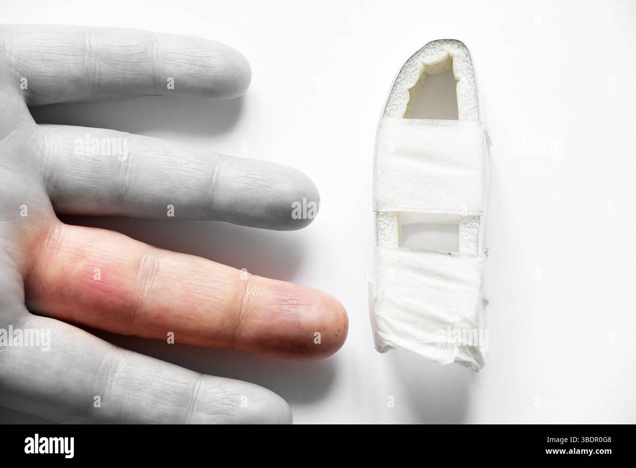 Broken finger with medical splint, male hand injury, swelling and ...