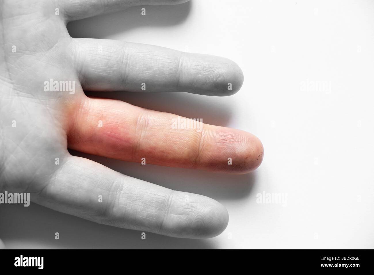Broken male finger on hand on white background, fracture and accident ...