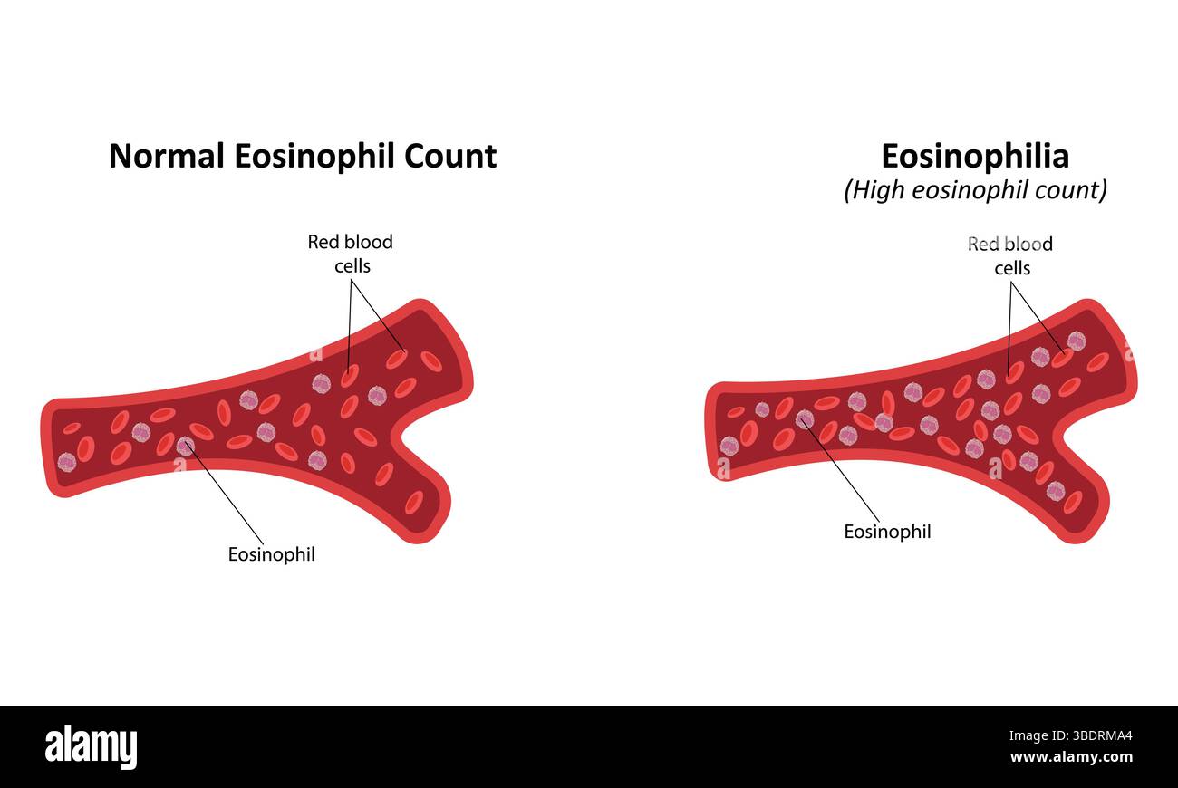 Eosinophilic cells Stock Vector Images - Alamy