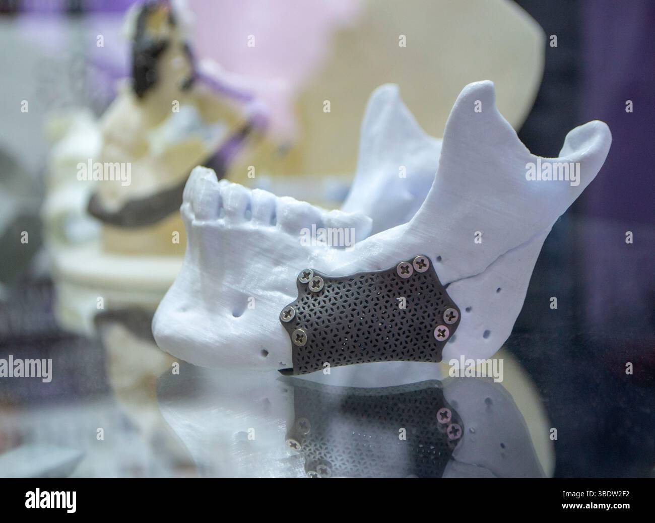Prototype of lower human jaw with medical titanium implant from ...