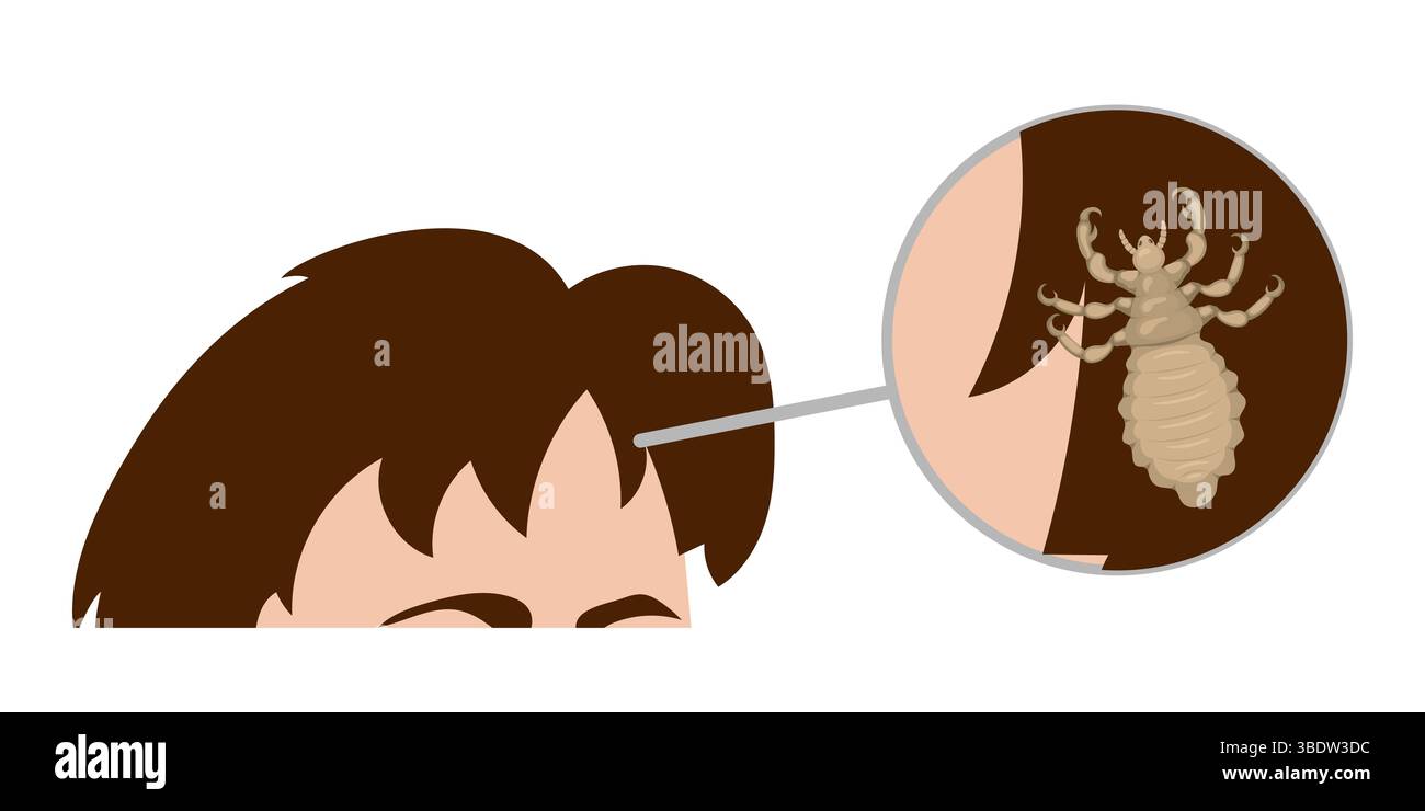Magnifying glass showing head louse attached to hair on persons head ...