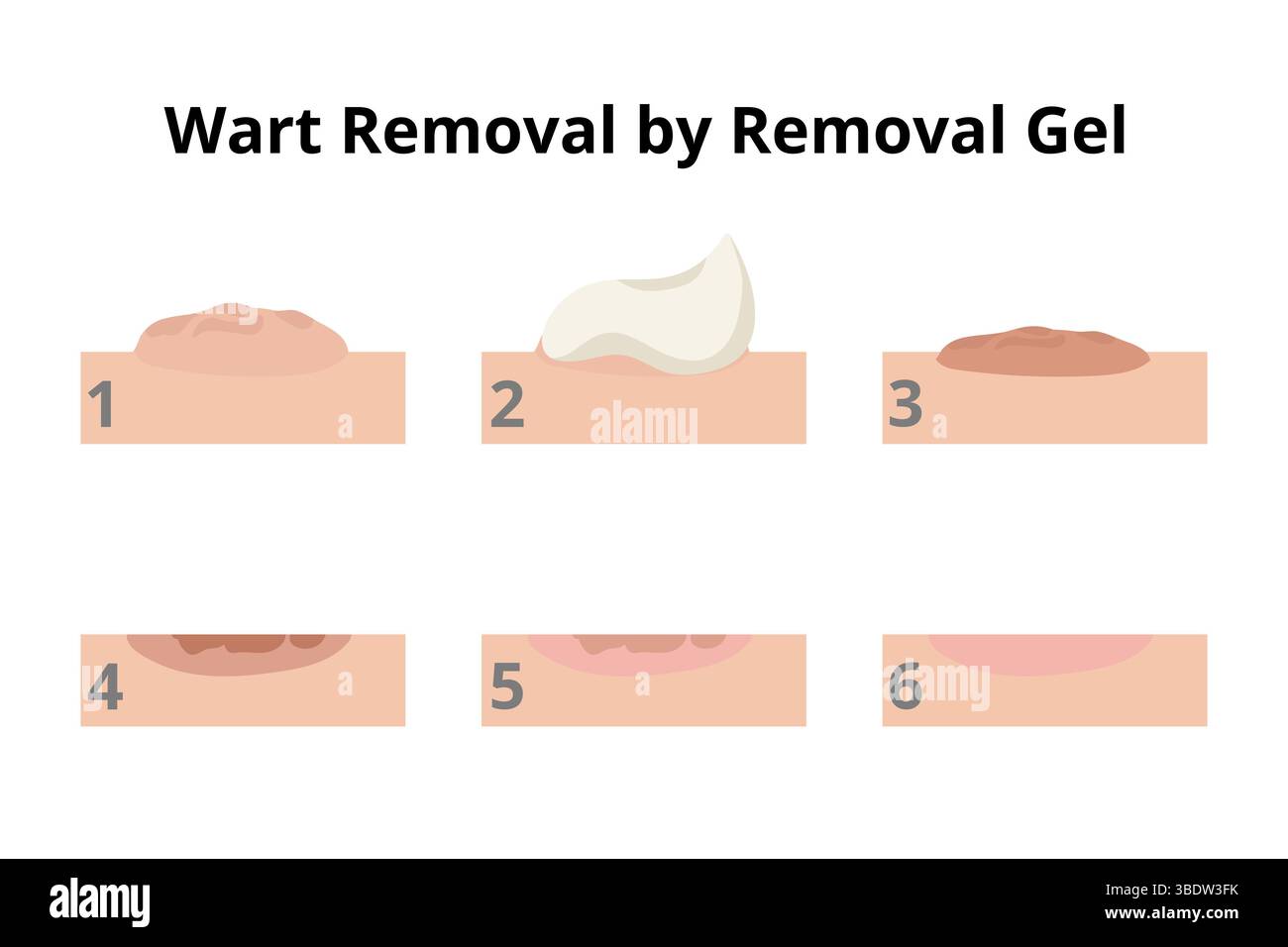Six step process showing the application of a removal gel on a wart ...
